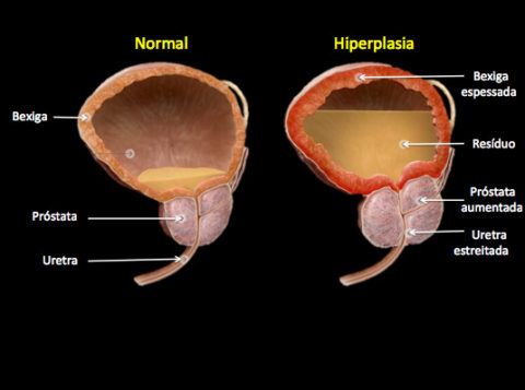 HPB – Hiperplasia Prostática Benigna - Dr. Claudio Ambrogini